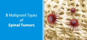 5 Types of Malignant Spinal Tumors | NJ Spine & Orthopedic