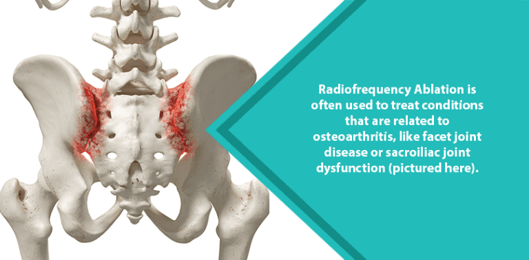 Radiofrequency Ablation for Nerve Pain | NJ Spine & Ortho