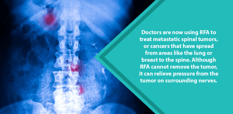 Radiofrequency Ablation for Nerve Pain | NJ Spine & Ortho