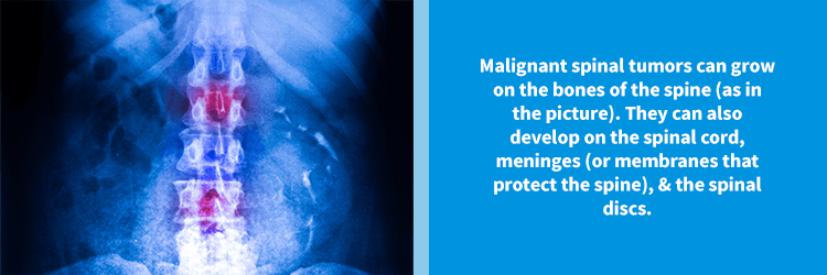 5 Types of Malignant Spinal Tumors | NJ Spine & Ortho Blog