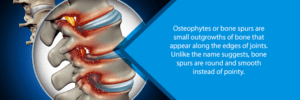 Getting to the Nerve (Root) of Spinal Bone Spurs | NJSO
