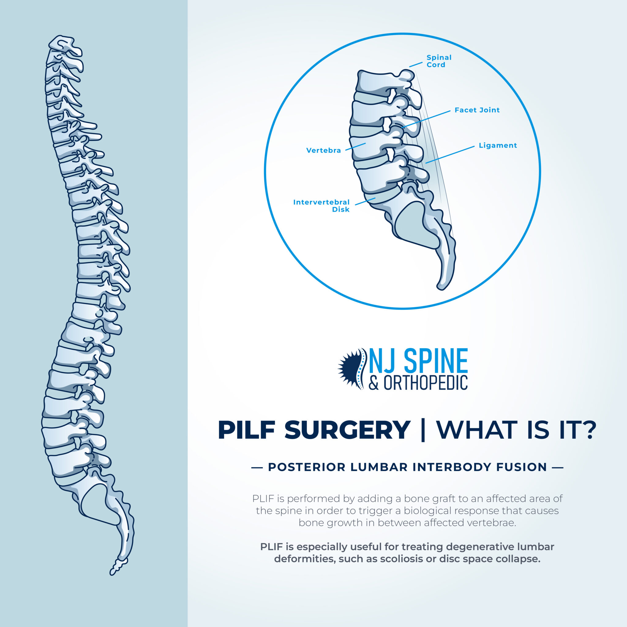 New Jersey Posterior Lumbar Interbody Fusion Surgery | PLIF Surgeons in NJ