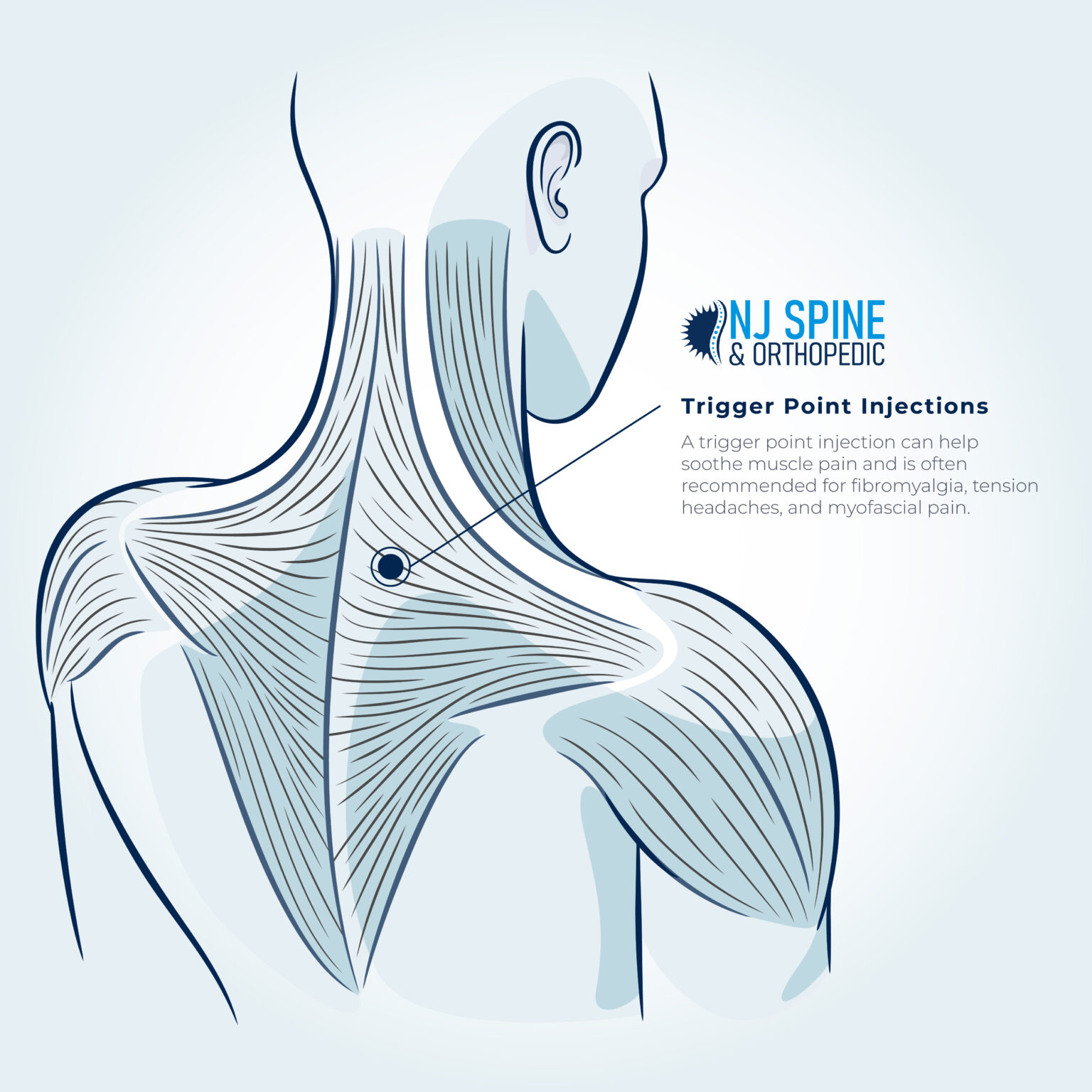 What Can I Expect From a Trigger Point Injection?