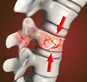 How Is a Spinal Compression Fracture Treated? | NJ Spine & Orthopedic