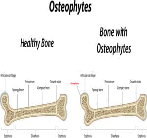 What Do Osteophytes in the Thoracic Spine Mean? | NJ Spine & Orthopedic
