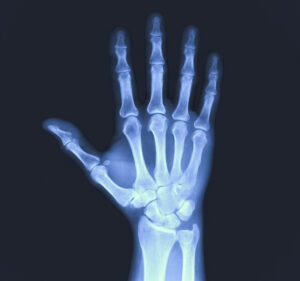 What Is a TFCC Tear and How Is It Treated? | NJ Spine & Orthopedic