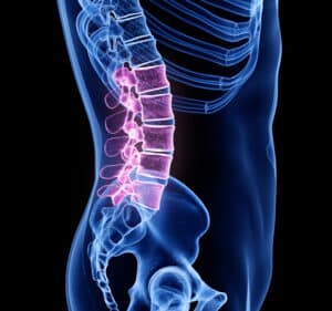 Pedicle Screws and Rods in Lumbar Spinal Fusion | NJ Spine & Orthopedic