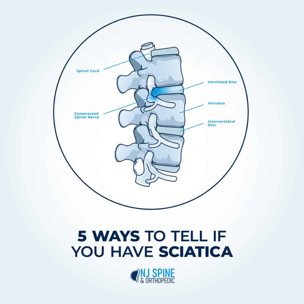 Do I Have Sciatica? Five Ways to Diagnose